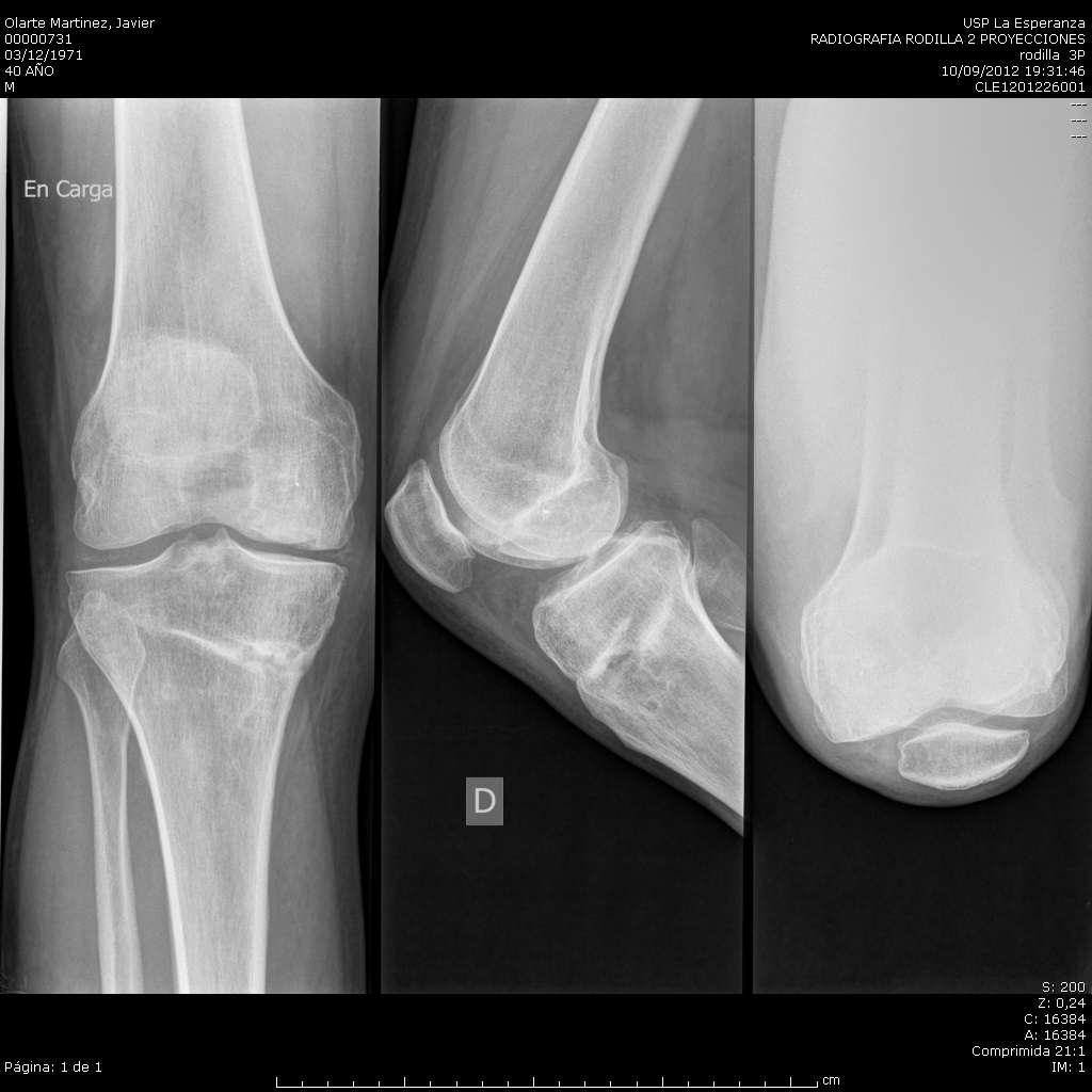 Rodilla | Patologías | Unidad de Cirugía Artroscópica